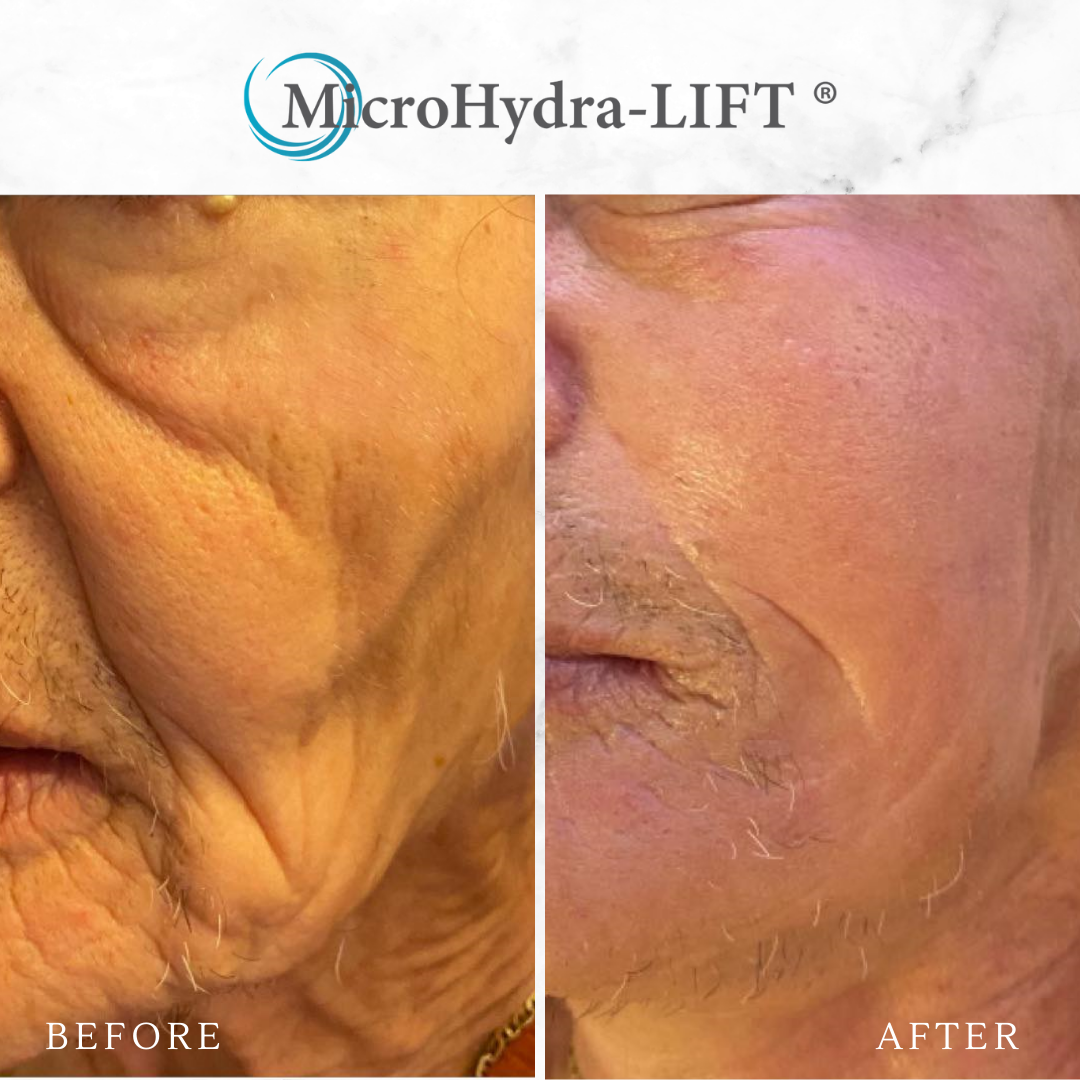 MICROHYDRA-LIFT ® - MEDISPA SOLUTIONS