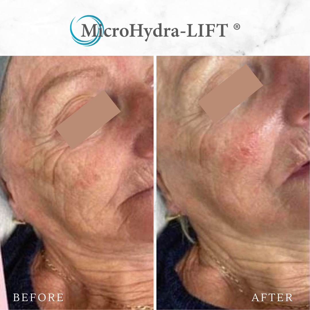 MICROHYDRA-LIFT ® - MEDISPA SOLUTIONS