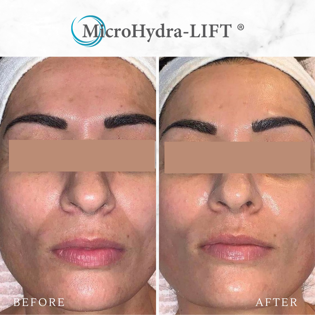 MICROHYDRA-LIFT ® - MEDISPA SOLUTIONS